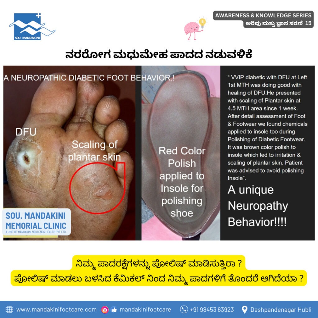 Neuropathic Diabetic Foot Behavior - Mandakini Foot Care