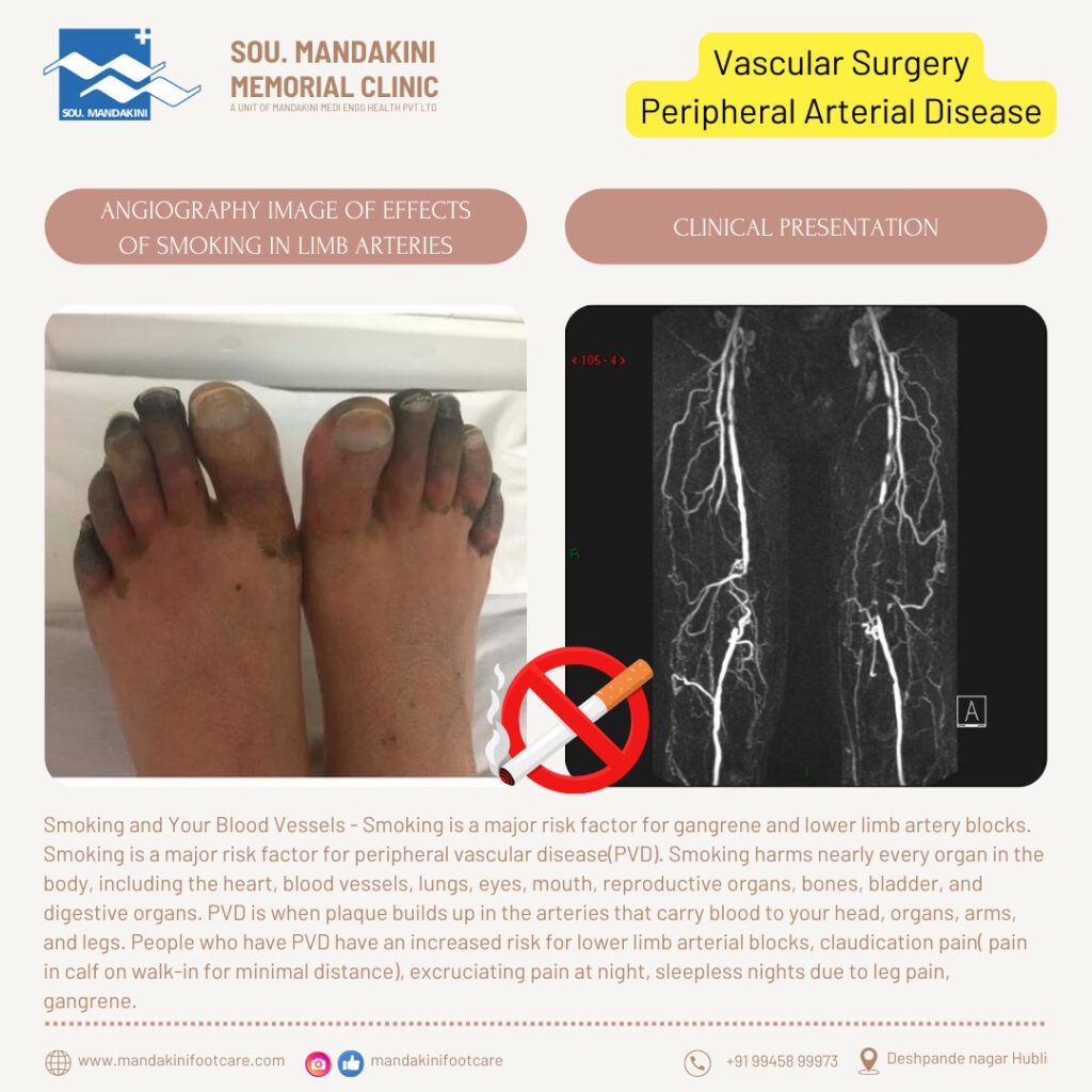 Peripheral Arterial Disease - Mandakini Foot Care